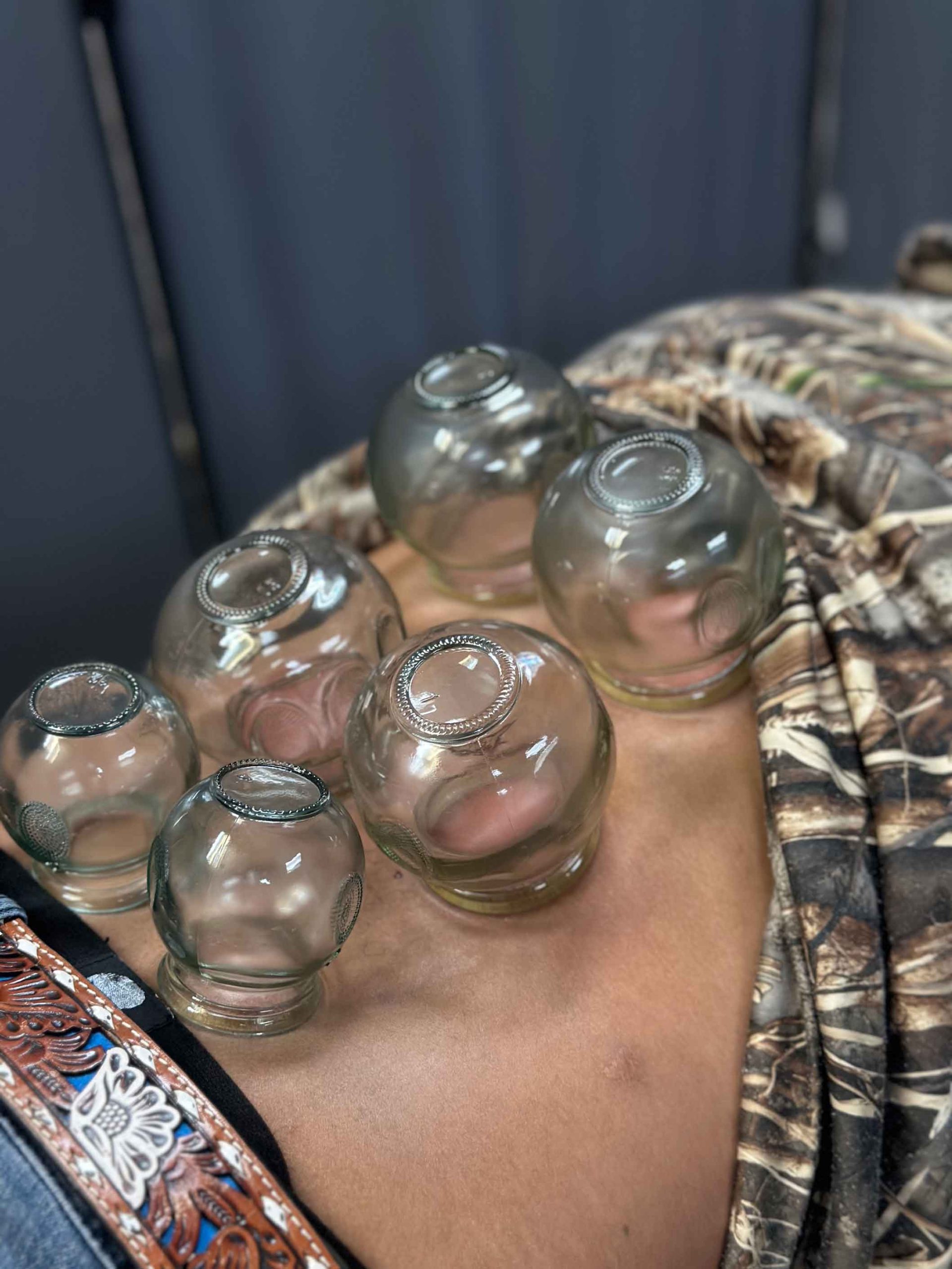 Advanced Fire Cupping Therapy | Back 2 Health Chiropractic, Lubbock, TX
